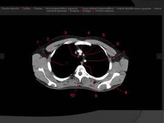 ANatomia Basica de Torax | PPTX