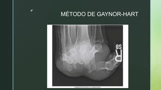 EXPOSICION SINDROME DEL TUNEL DEL CARPO 1.pptx