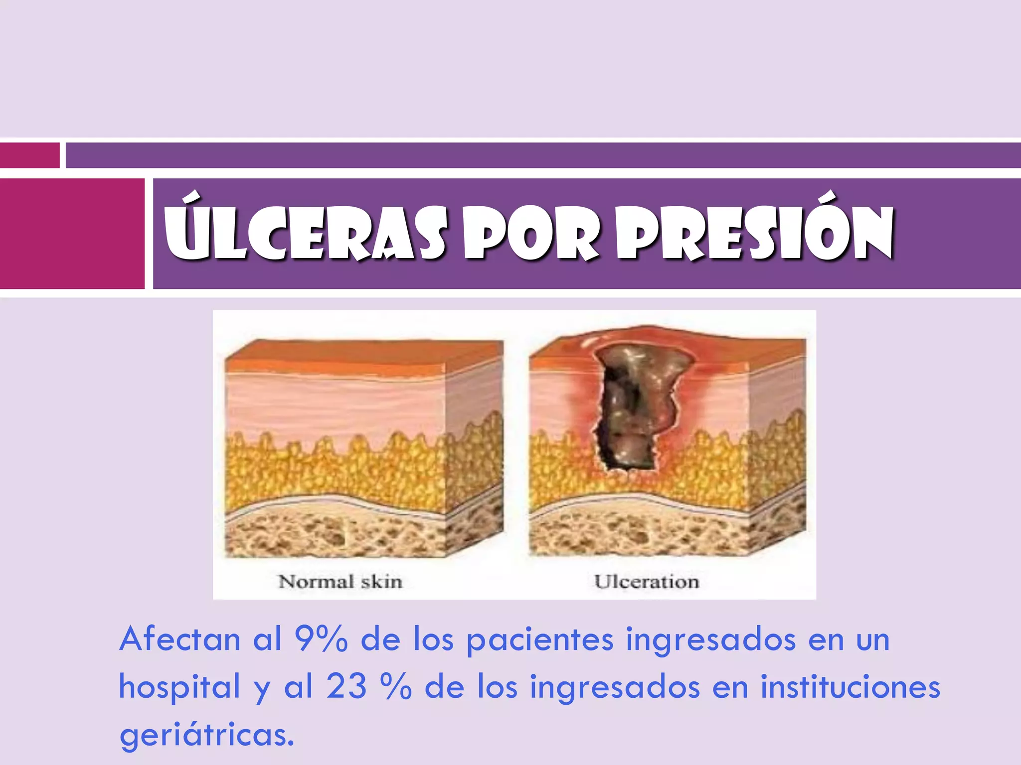 ULCERAS POR PRESION | PDF