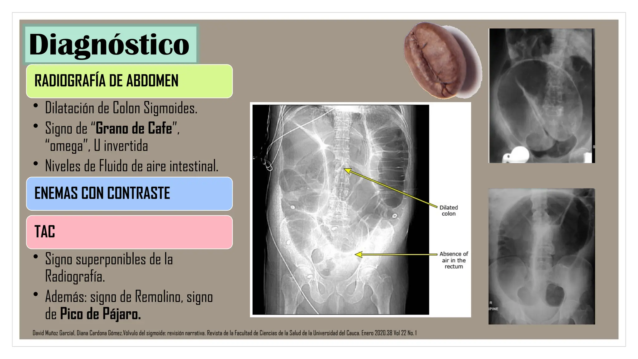 volvulo de sigmoides caracteristicas y clinica | PPTX