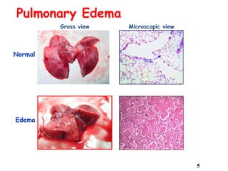 Exp pulmonary edema | PPT