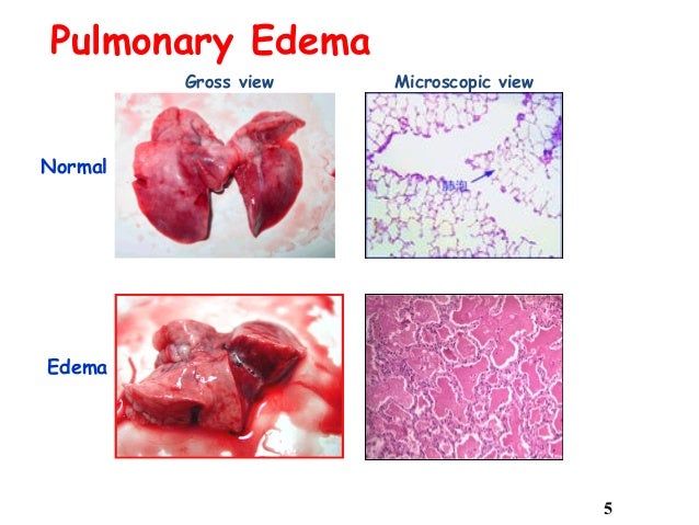 Exp pulmonary edema