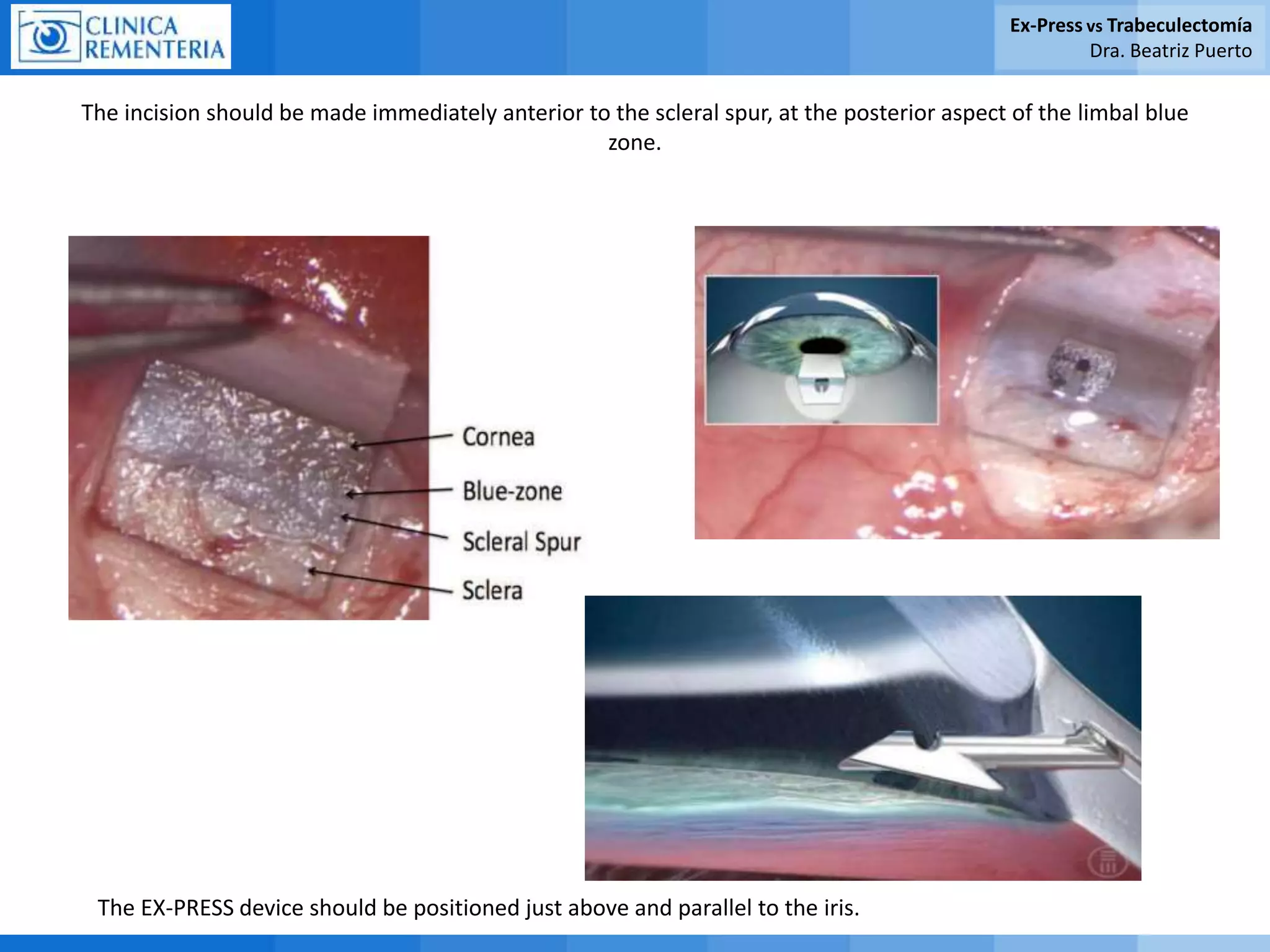 Glaucoma: Implante Ex-press vs Trabeculectomia | PPTX