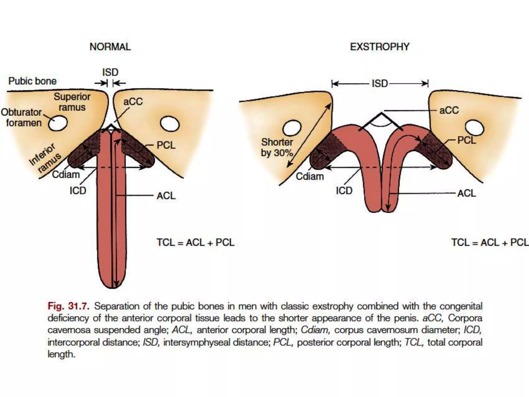 Exstrophy Epispadias complex | PPTX