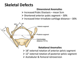 Exstrophy Epispadias complex | PPTX