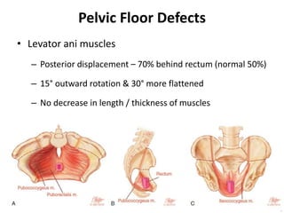 Exstrophy Epispadias complex | PPTX