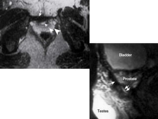 Exstrophy Epispadias complex | PPT