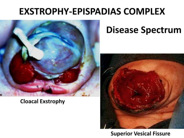 Exstrophy Epispadias complex | PPT