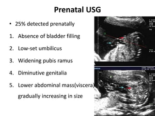 Exstrophy Epispadias complex | PPT