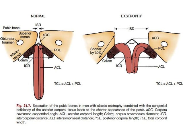 Exstrophy Epispadias complex