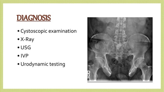 Exstrophy of bladder | PPT