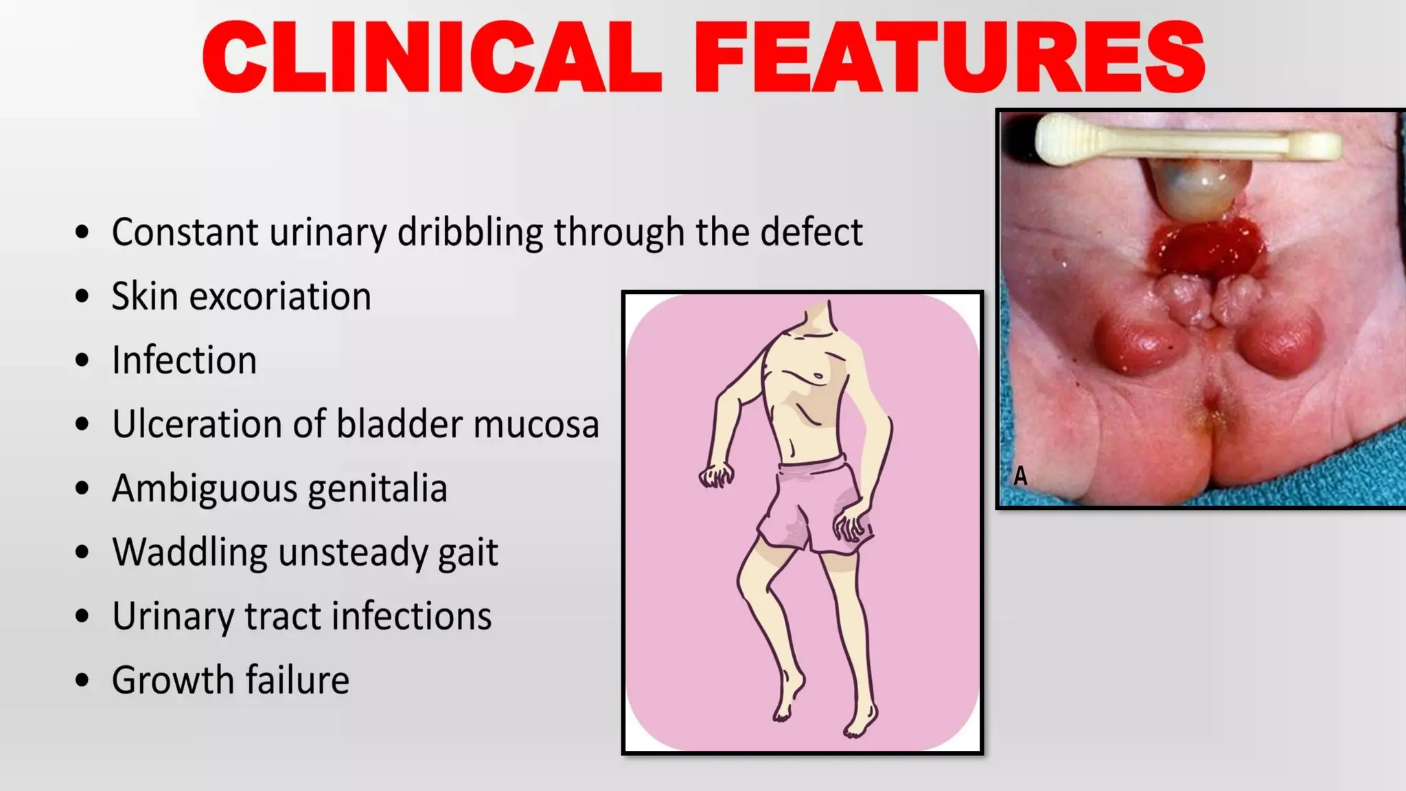 exstrophy of bladder/ urinary bladder extrophy.pptx