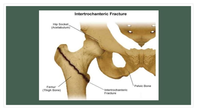 Intertrochanteric Fracture | PPT