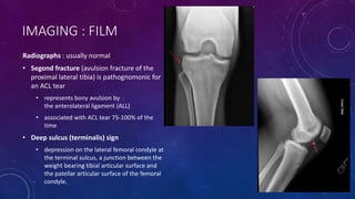ACL INJURY | PPT