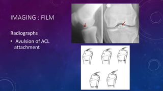 ACL INJURY | PPT