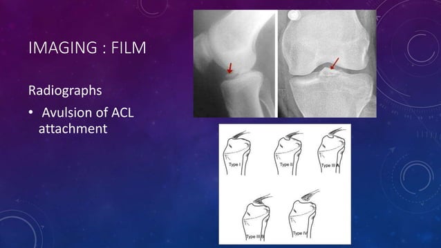 ACL INJURY | PPT