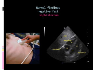 Extended focused abdominal assesment in trauma patients | PPTX