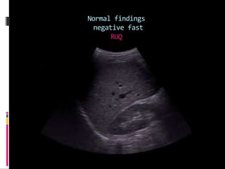 Extended focused abdominal assesment in trauma patients | PPTX