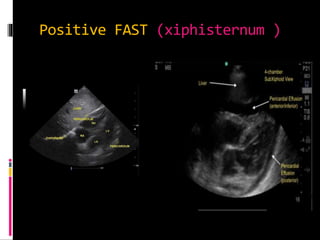 Extended focused abdominal assesment in trauma patients | PPTX