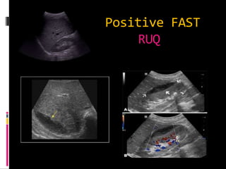 Extended focused abdominal assesment in trauma patients | PPTX