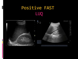 Extended focused abdominal assesment in trauma patients | PPTX