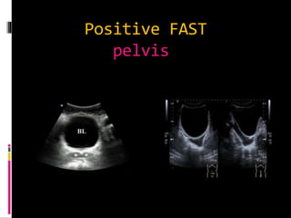 Extended focused abdominal assesment in trauma patients | PPTX