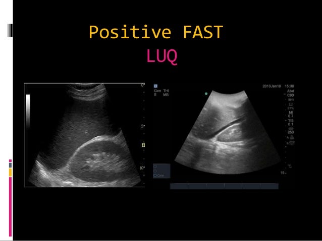 Extended focused abdominal assesment in trauma patients