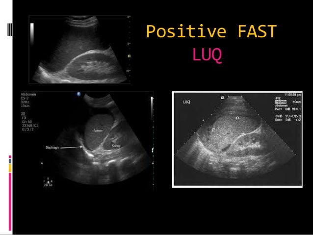 Extended focused abdominal assesment in trauma patients