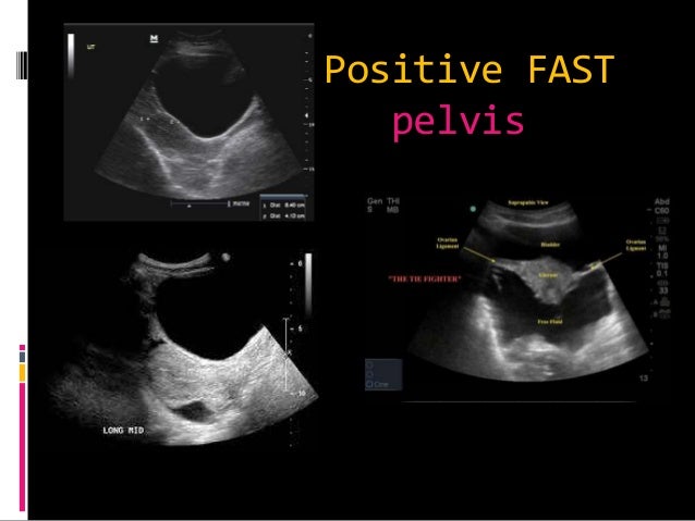 Extended focused abdominal assesment in trauma patients