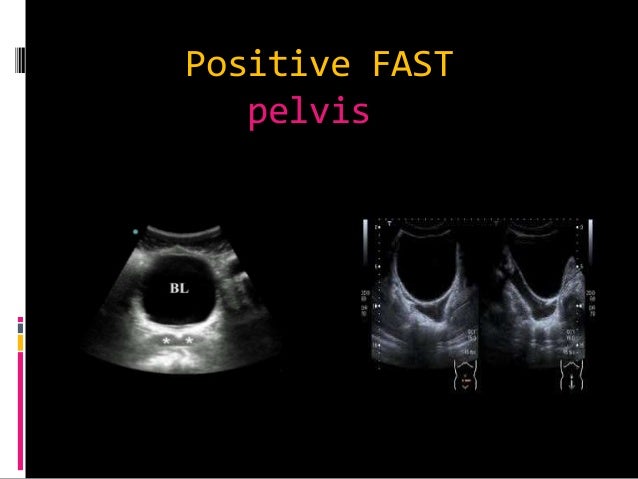 Extended focused abdominal assesment in trauma patients