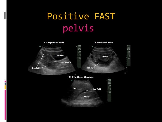 Extended focused abdominal assesment in trauma patients