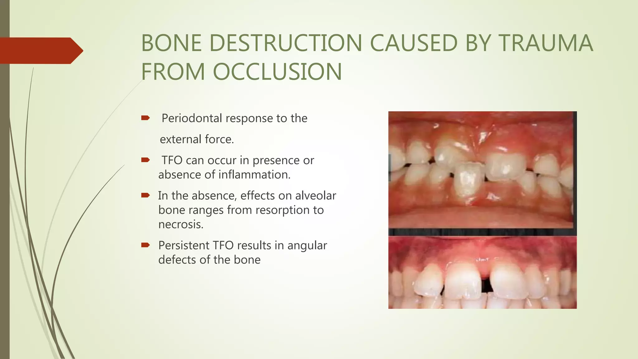 Extension of inflamation from gingiva to periodontal tissues and bone ...