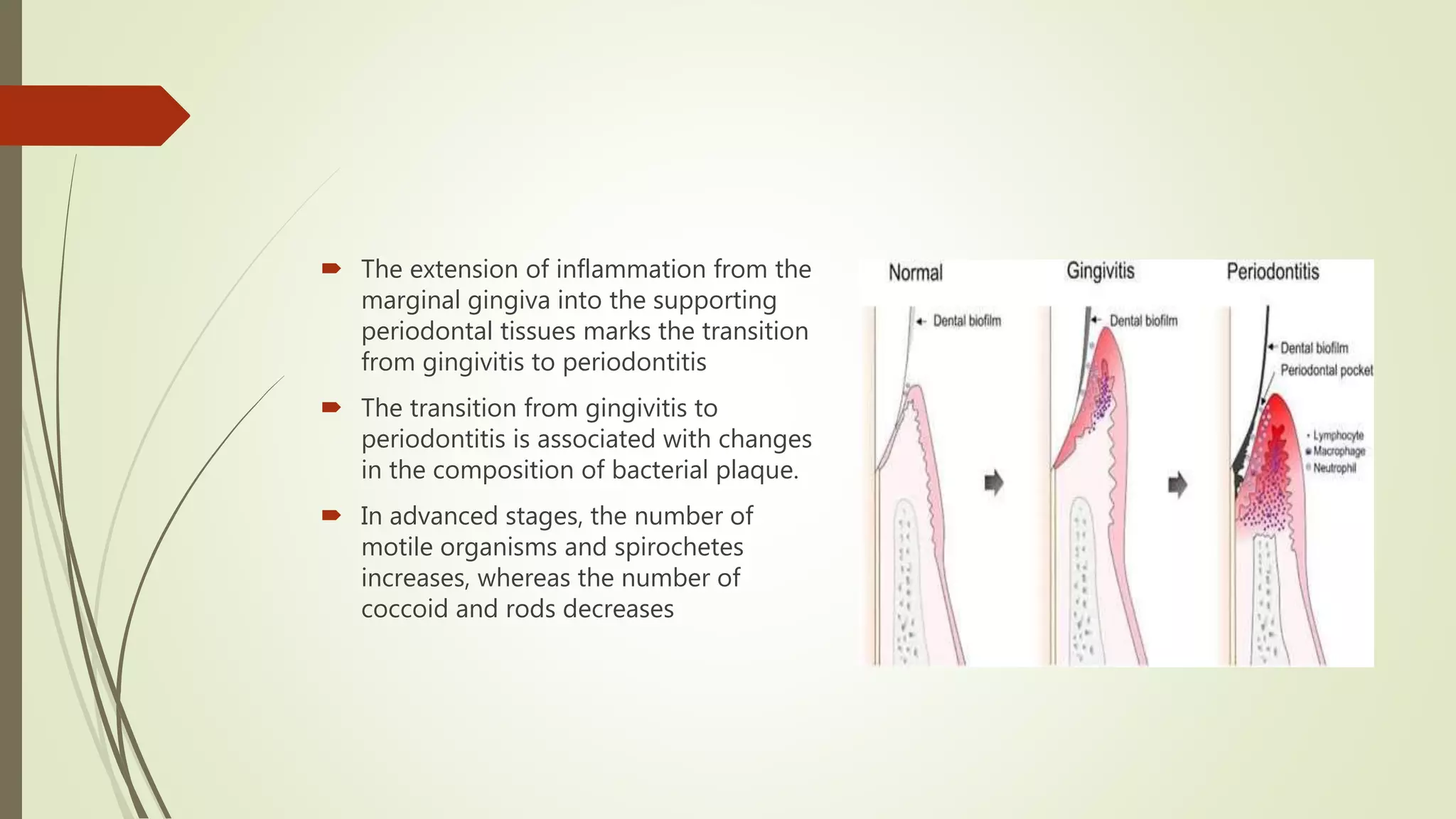 Extension of inflamation from gingiva to periodontal tissues and bone ...