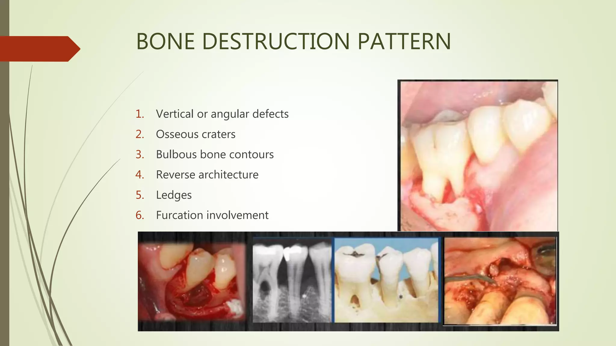 Extension of inflamation from gingiva to periodontal tissues and bone ...