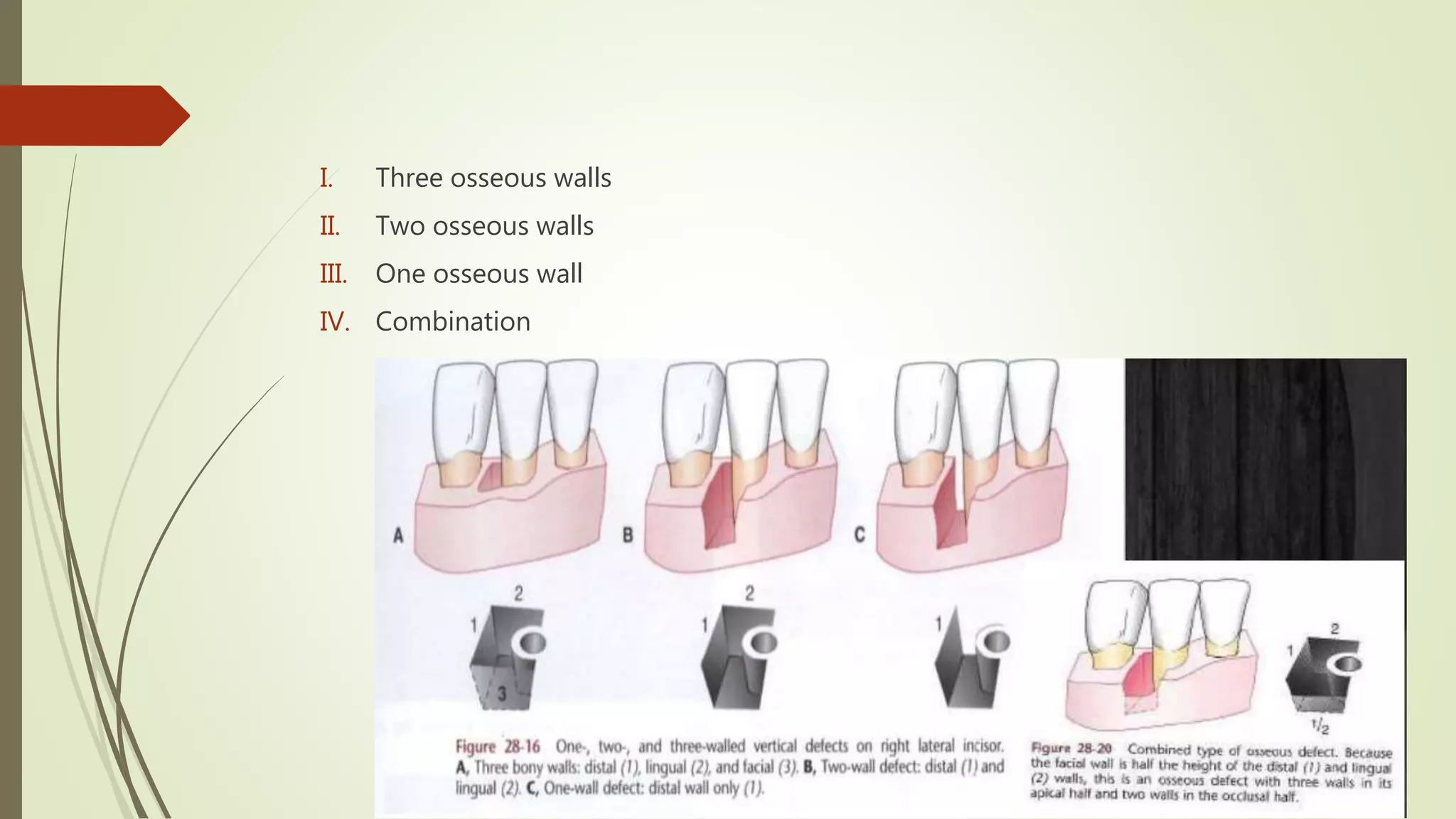 Extension of inflamation from gingiva to periodontal tissues and bone ...