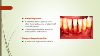 Extension of inflamation from gingiva to periodontal tissues and bone ...