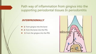 Extension of inflamation from gingiva to periodontal tissues and bone ...