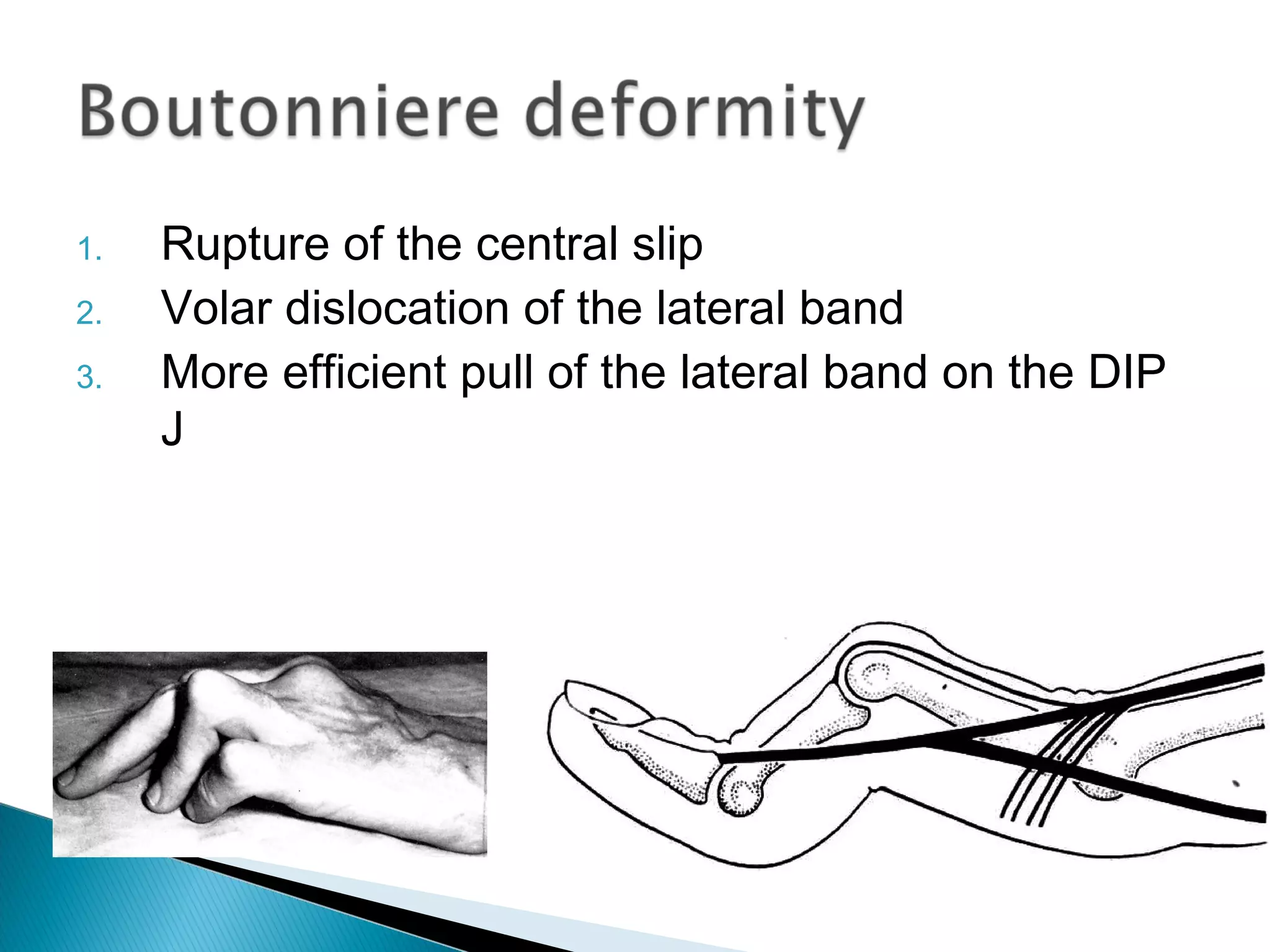 Extensor apparatus hand | PPT