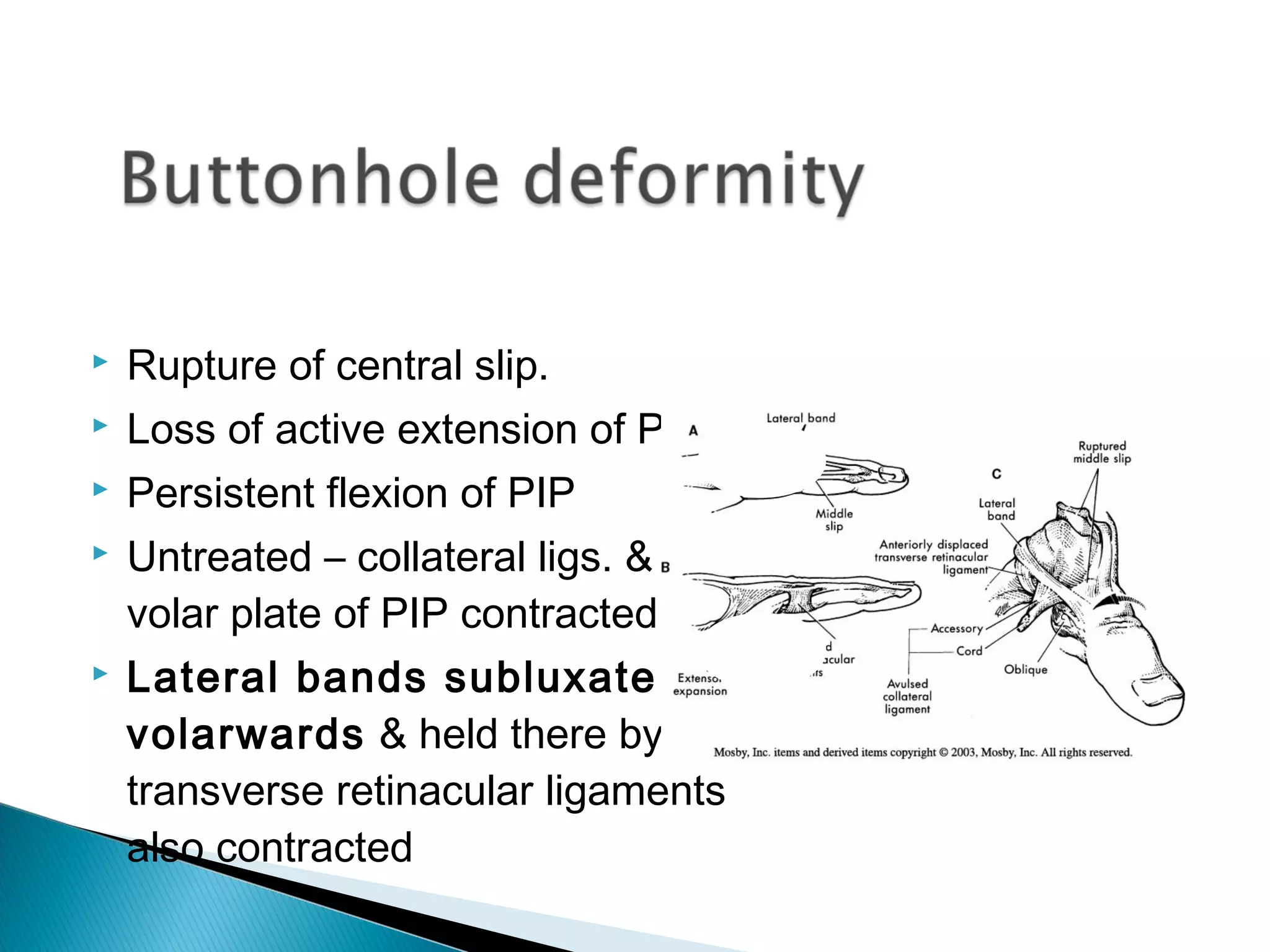 Extensor apparatus hand | PPT