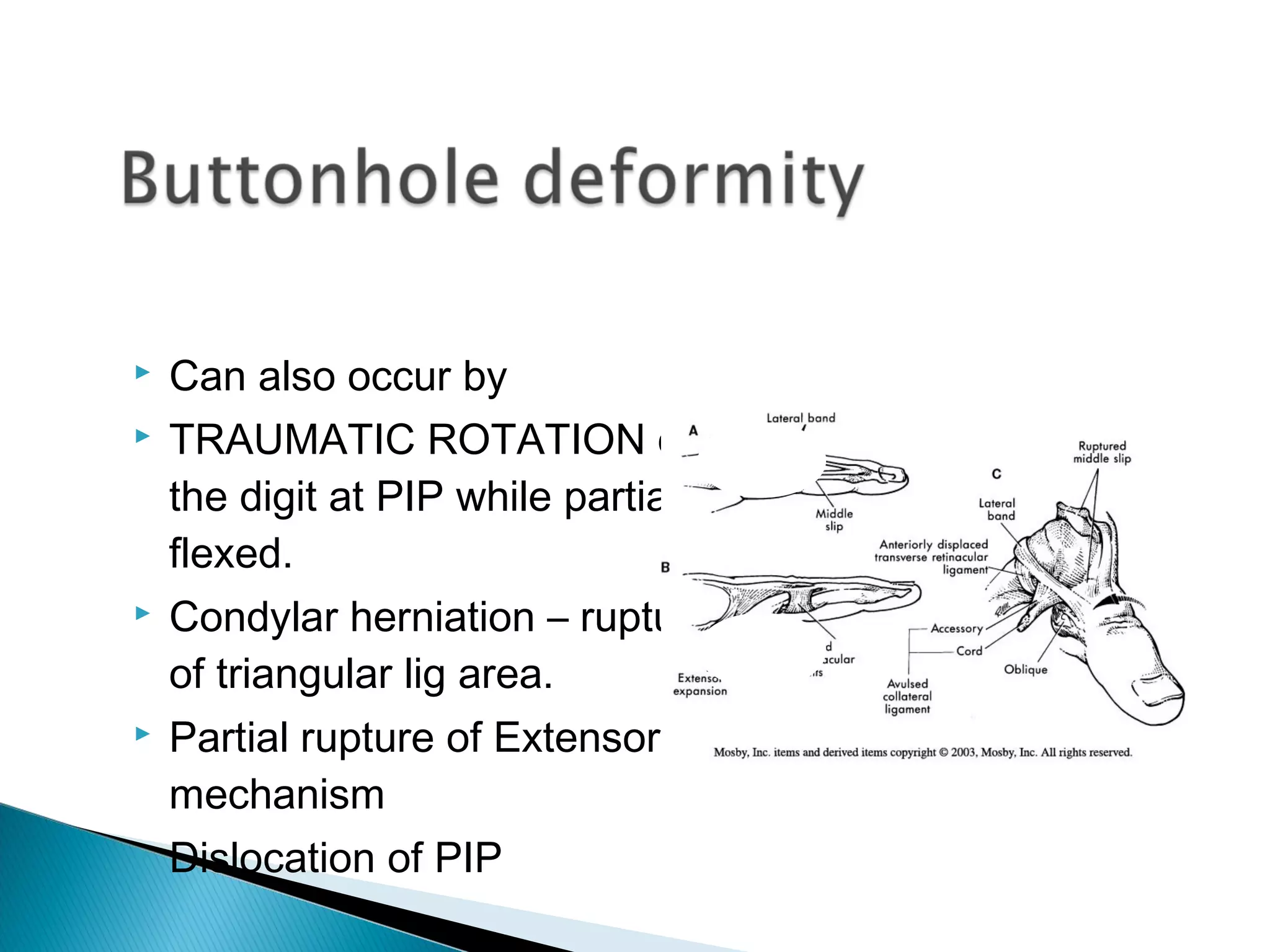 Extensor apparatus hand | PPT