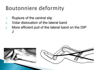 Extensor apparatus hand | PPT