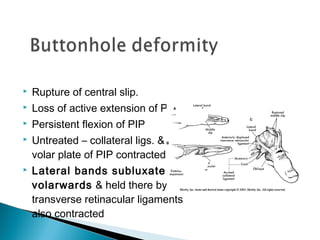Extensor apparatus hand | PPT