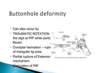 Extensor apparatus hand | PPT