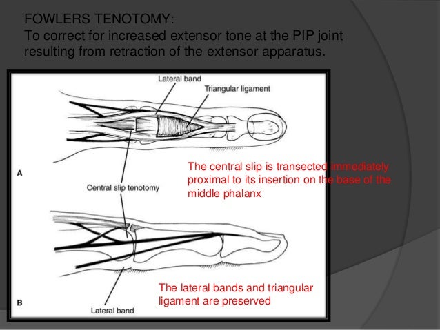 Extensorapparatusofhandinjuries