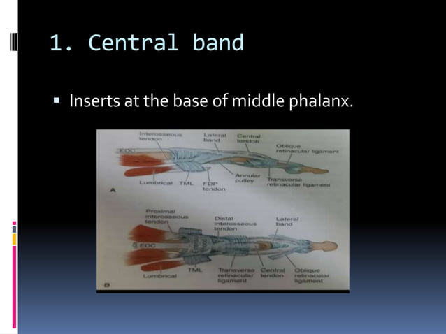 Extensor mechanism of finger | PPTX