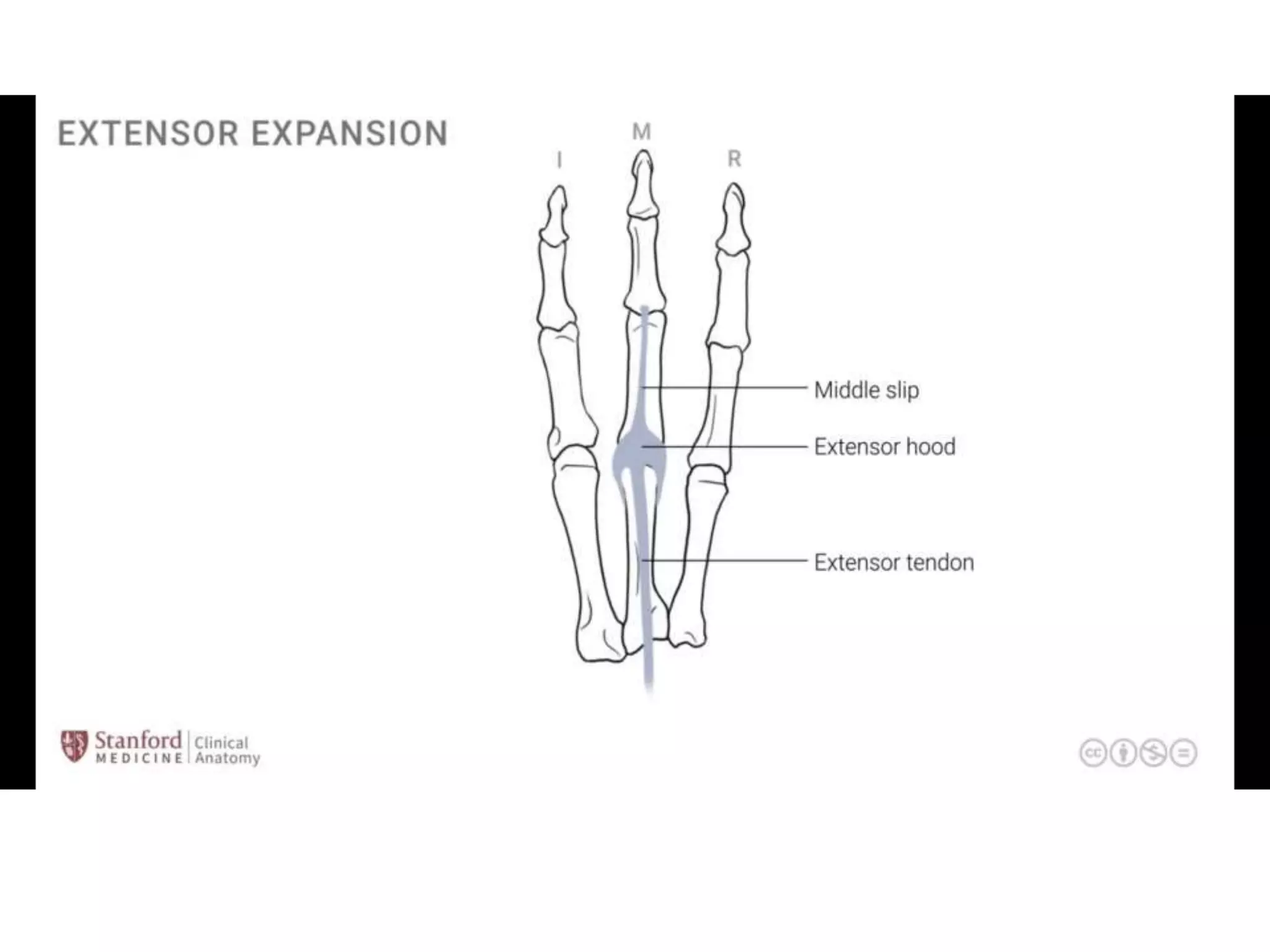 Extensor tendon injuries hand | PPTX