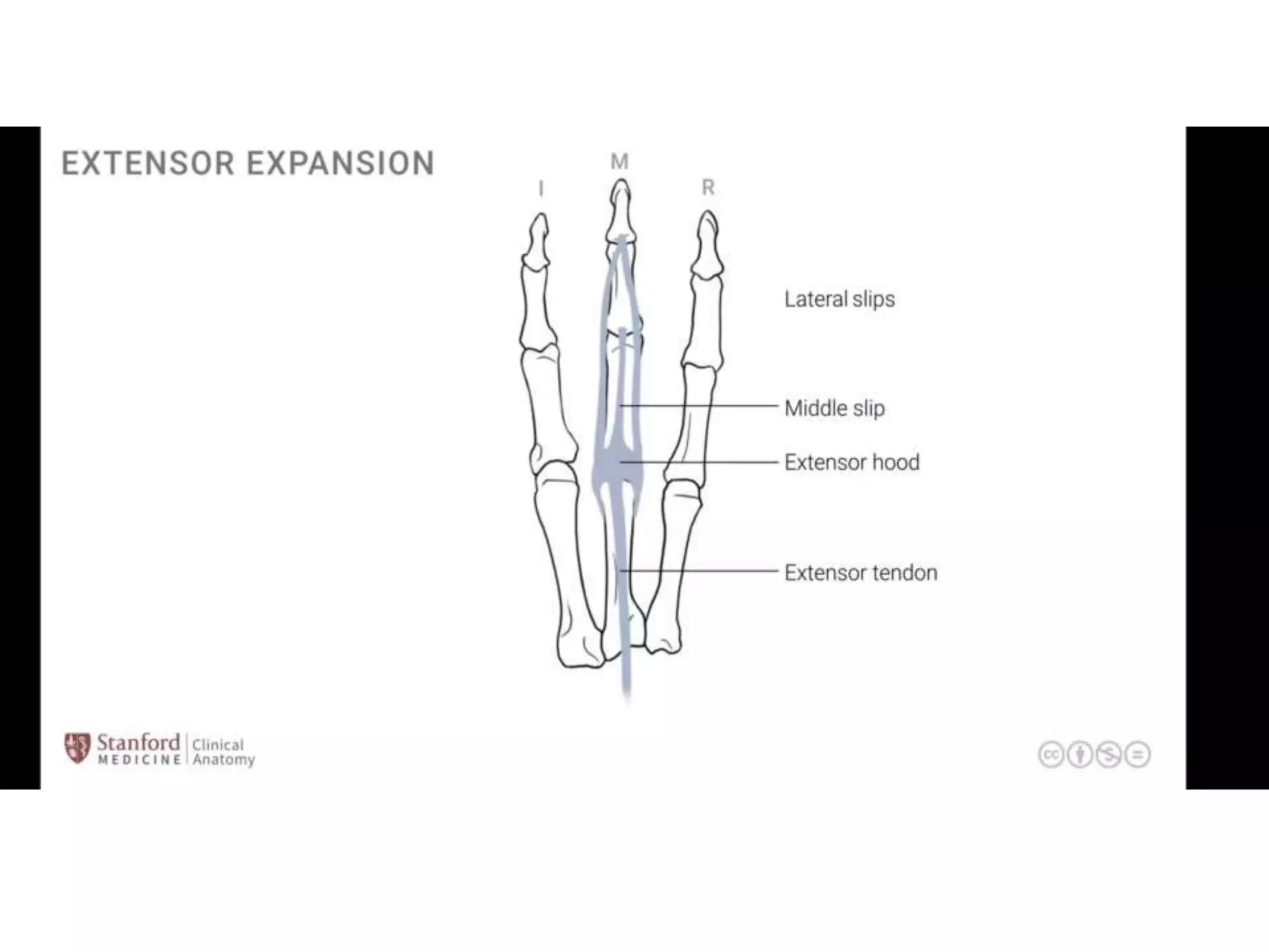 Extensor tendon injuries hand | PPTX