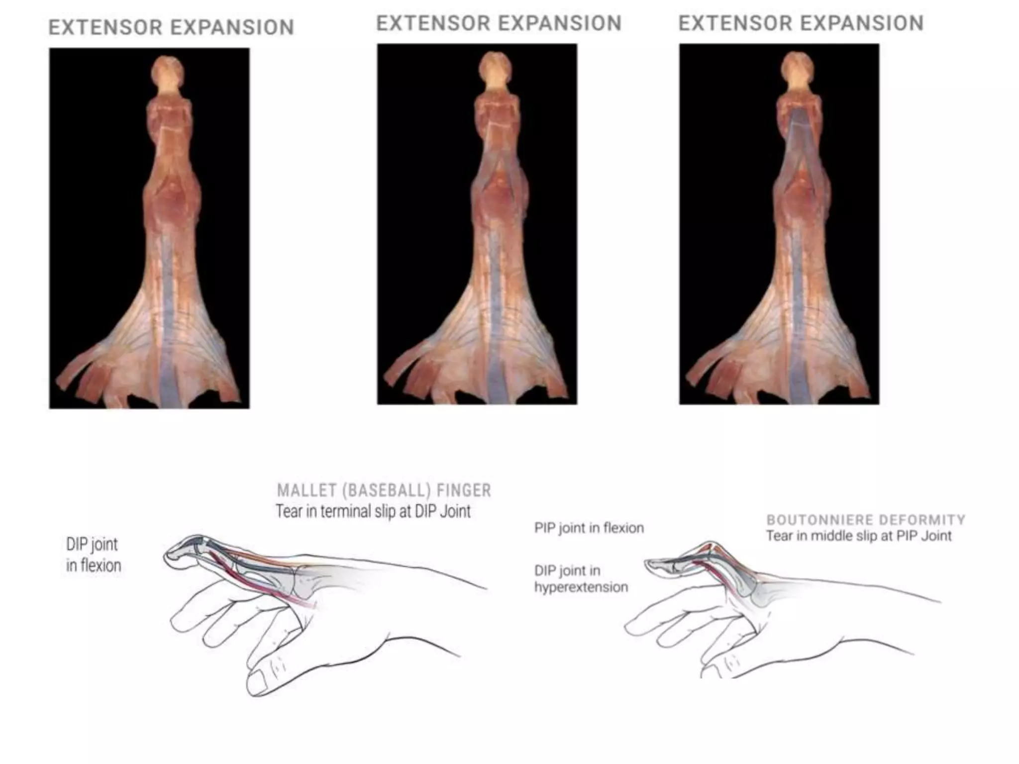 Extensor tendon injuries hand | PPTX | Death, Injury, or Military ...