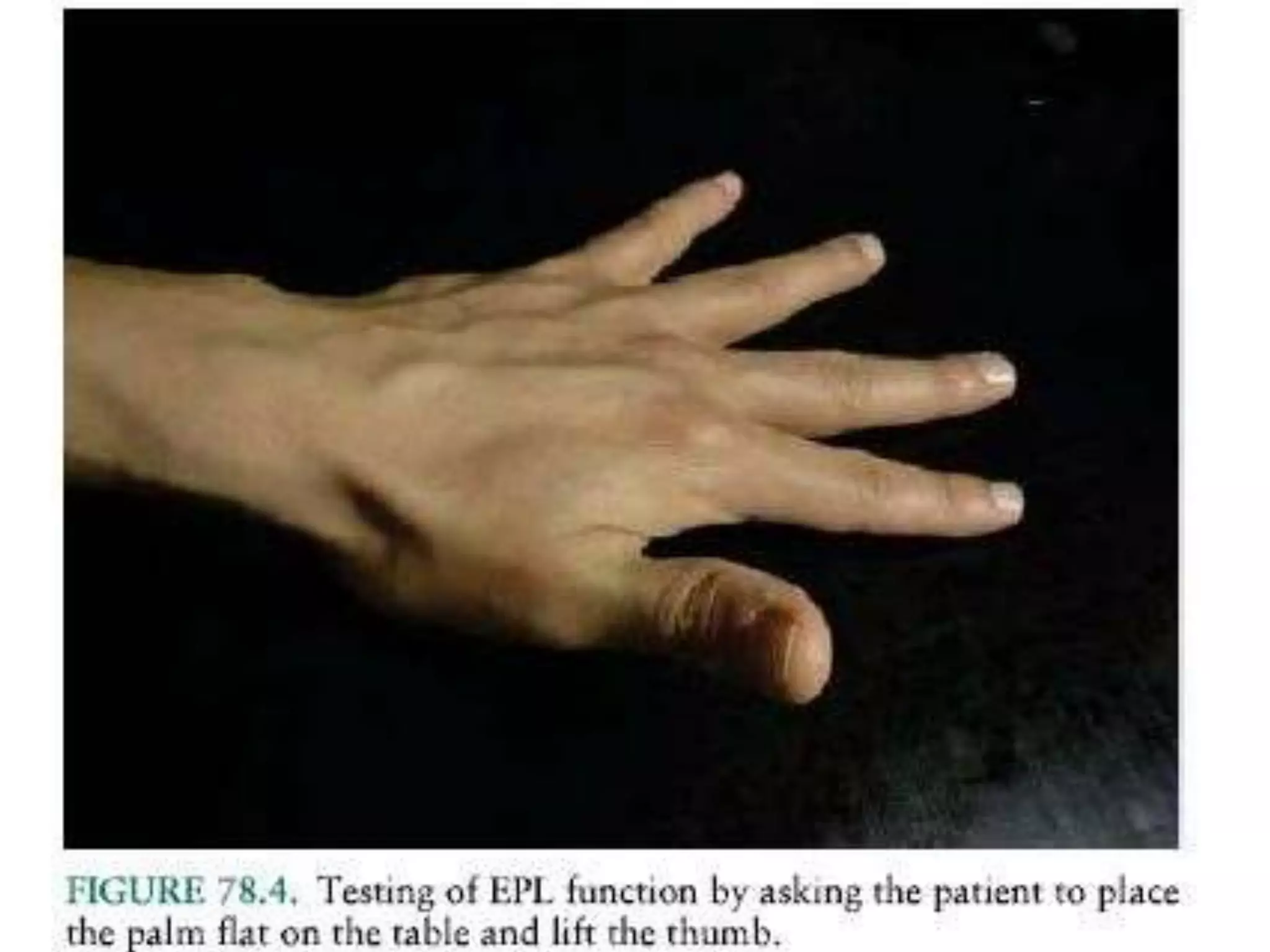 Extensor tendon injuries hand | PPTX