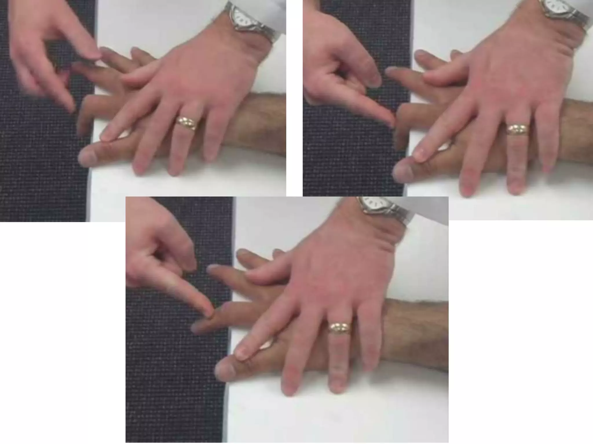 Extensor tendon injuries hand | PPTX